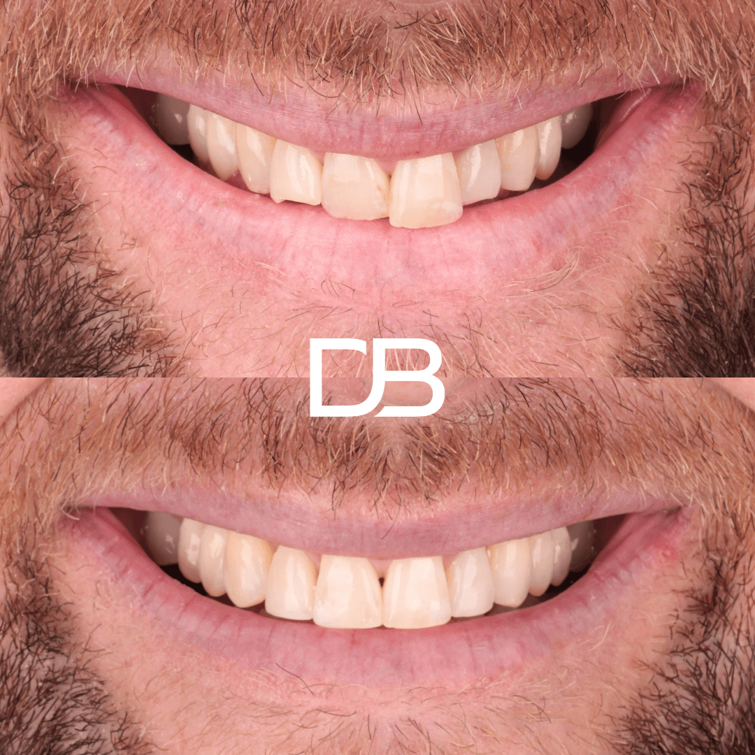 Dental Implant Overdenture | Dental Boutique